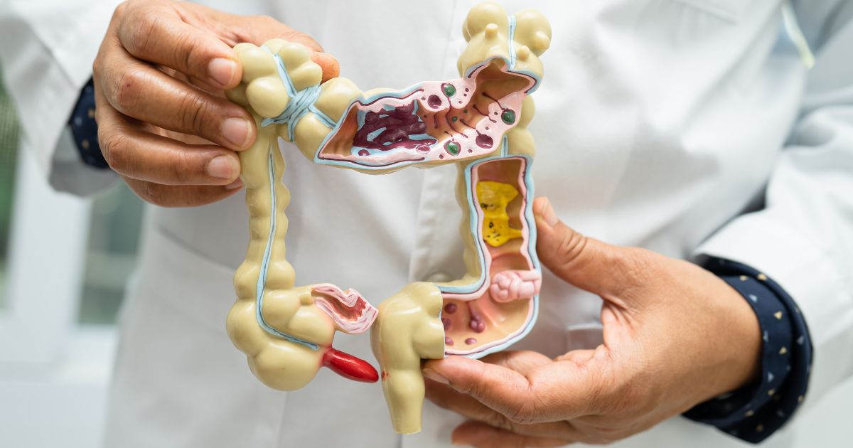 Doença Diverticular x Diverticulite: entenda as diferenças